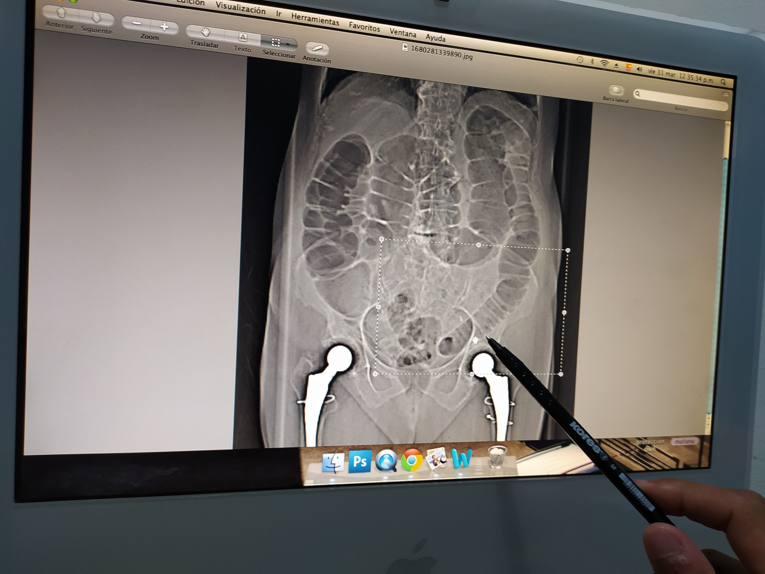 Quincuagenarios son más propensos a desarrollar cáncer de colon ...